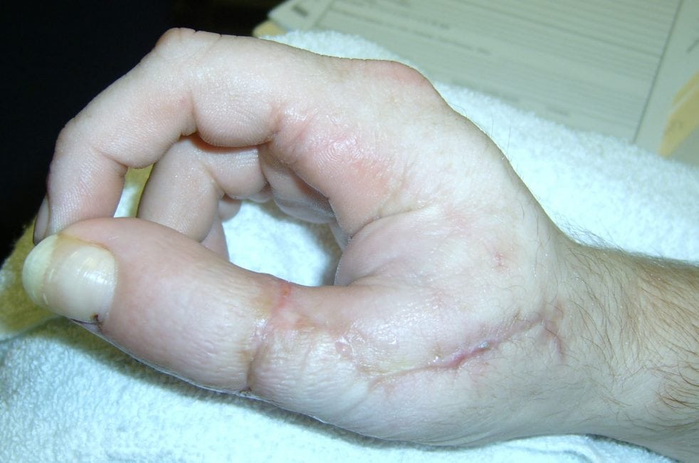 Tricky Case - Exploring Hand Therapy